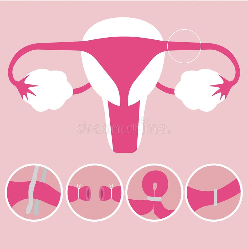 Medical Tubal Ligation for Female Stock Vector - Illustration of ...