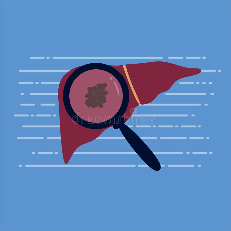 Cancer Diagnose in Human Liver Stock Vector - Illustration of liver ...