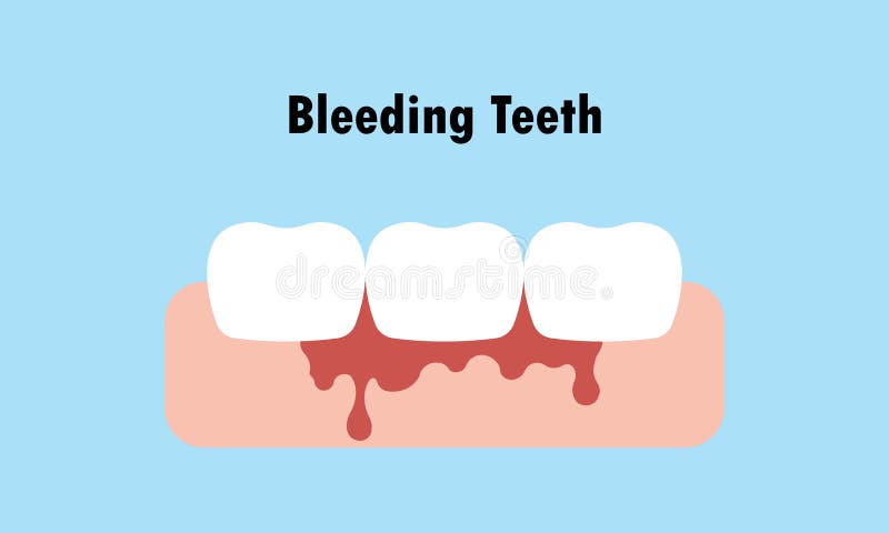 Bleeding White teeth stock vector. Illustration of clinic - 277311618
