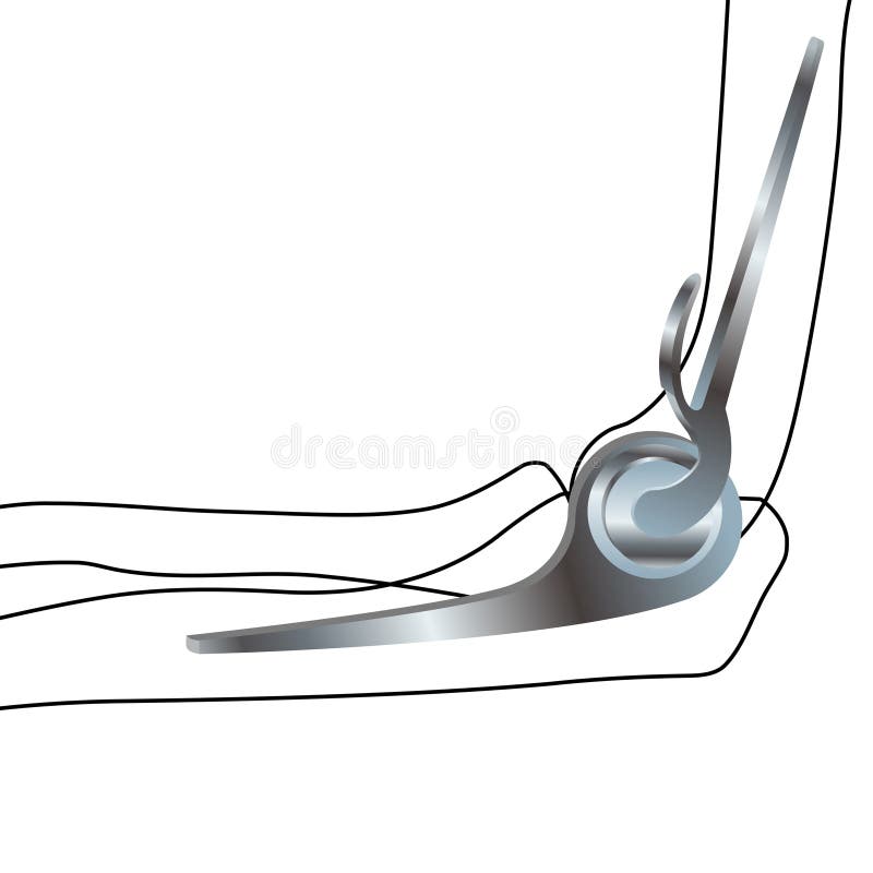 Endoprosthetics, Elbow Joint Prosthesis. Vector Illustration Stock ...