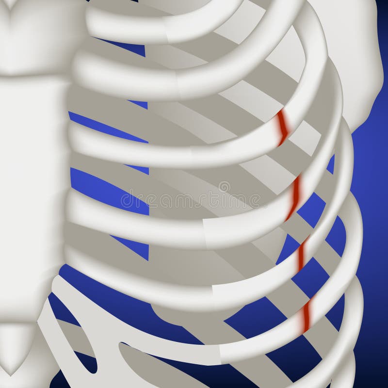 Broken Ribs on a Blue Background, Close-up. Stock Vector - Illustration ...