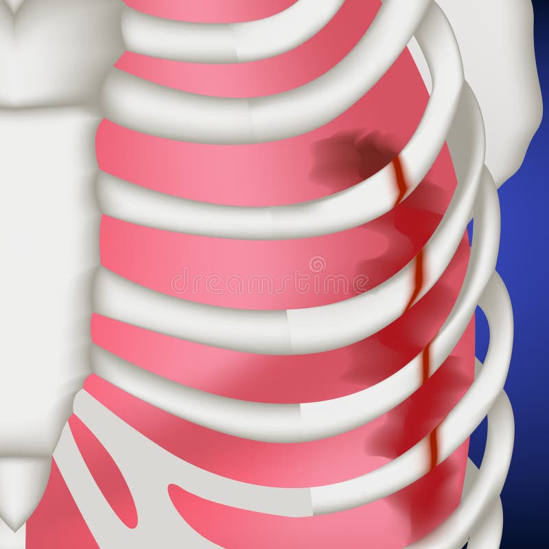 Broken Ribs of a Man with Lung Damage. Stock Vector - Illustration of ...