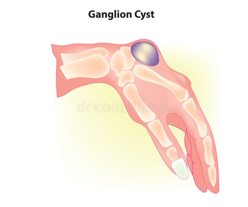 Ganglion cyst stock vector. Illustration of labeled - 321217330