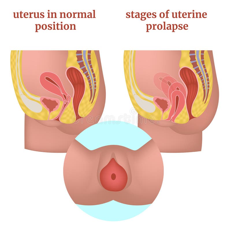 Stages of Uterine Prolapse. Female Reproductive Organs Diagram and Disease Infographic Stock ...