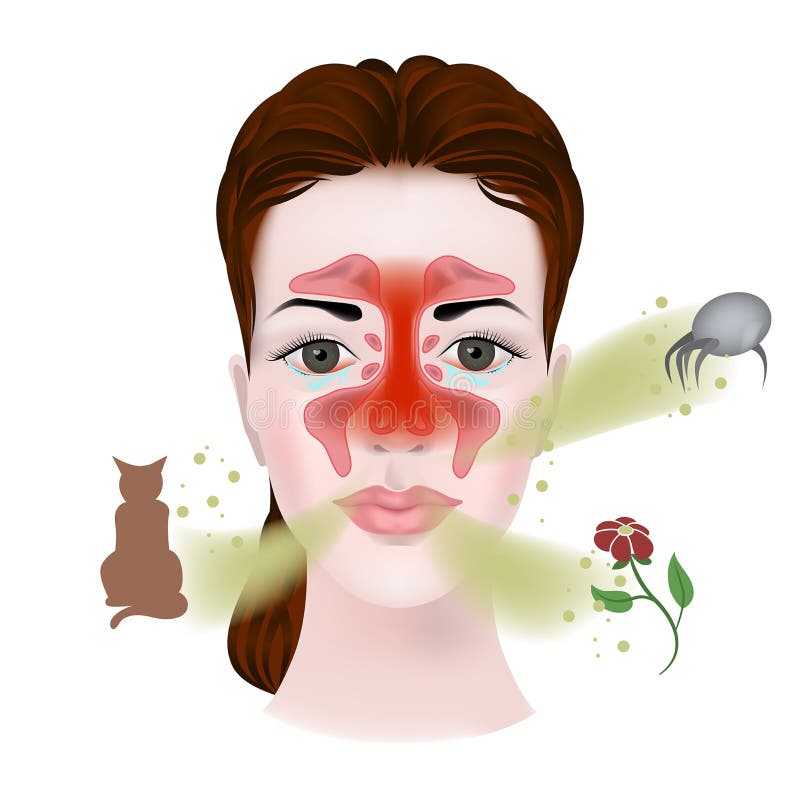 Allergic Rhinitis. Medical Poster Concept Stock Vector - Illustration ...