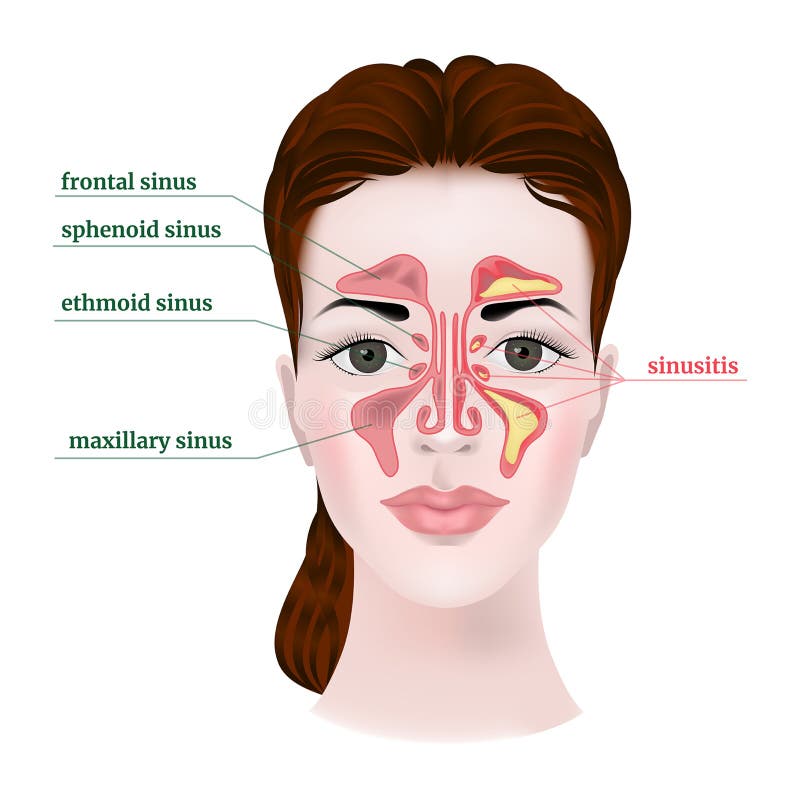 The Face of a Girl with the Anatomy of the Maxillary Sinuses, with a ...