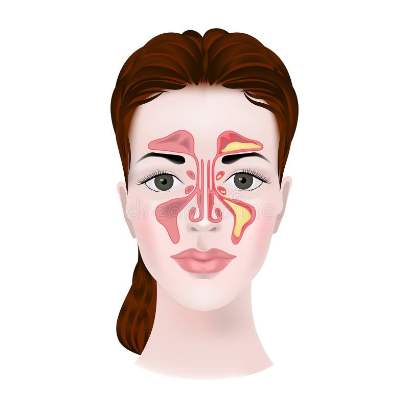 Sinusitis. Image of the Maxillary Sinuses on a Woman S Face with a ...