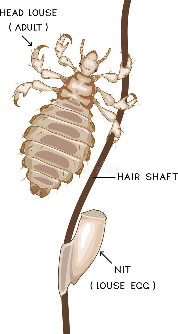 Male Head Louse (Pediculus Humanus) Insect and Louse Egg (nit) Attached ...
