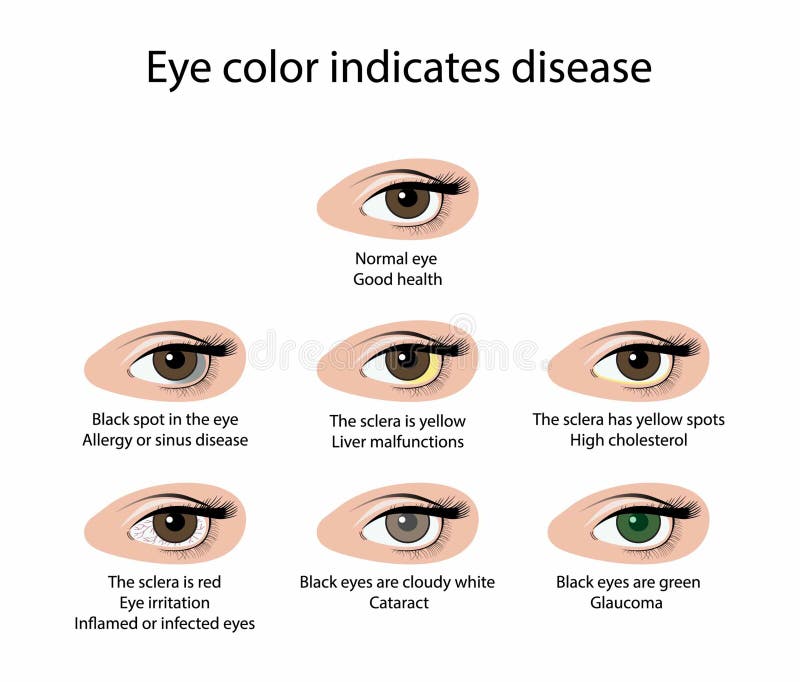 Illustration of Biology and Medical, Eye Color Indicates Disease, Signs ...