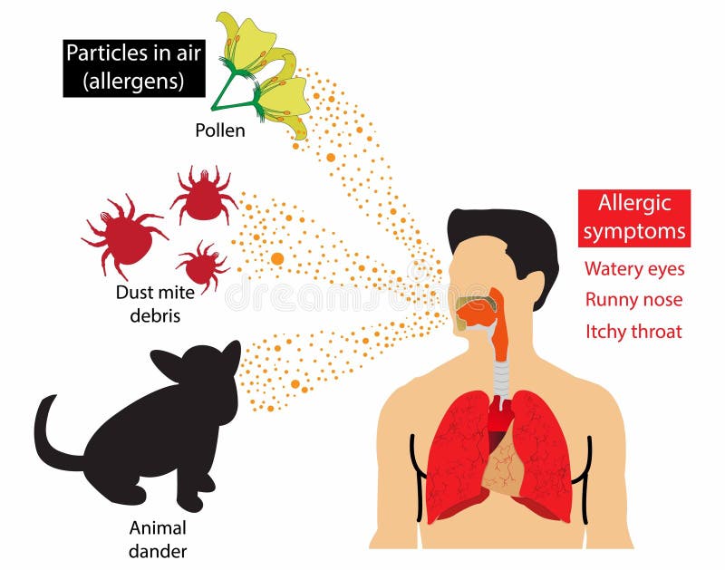 Illustration of Medical and Pollution, Symptoms of Airborne Allergies ...