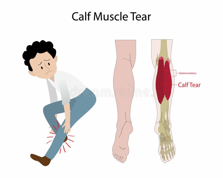 Illustration of Biology and Medical, Calf Tear and Torn Calf Muscle ...