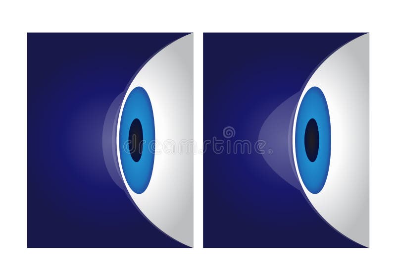 Eye Cornea and Keratoconus Vector / Anatomy Stock Vector - Illustration ...