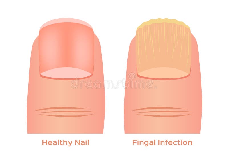 Vector Toe Nail Fungal Disease Stock Illustrations – 100 Vector Toe ...