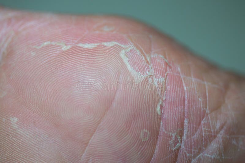 The Problem of Dry Peeling Skin Stock Image - Image of dermatitis ...