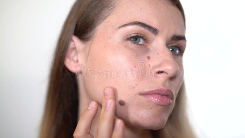 Problem moles on the face. stock footage. Video of medical - 263420172