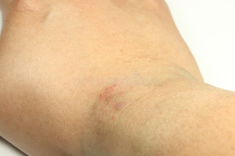 Skin Disease and Red Irritation. Stock Photo - Image of surface, limb ...