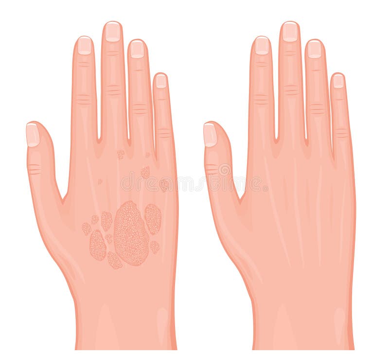 Problem_Treatment De Corps Humain De Psoriasis Dans Les Mains ...