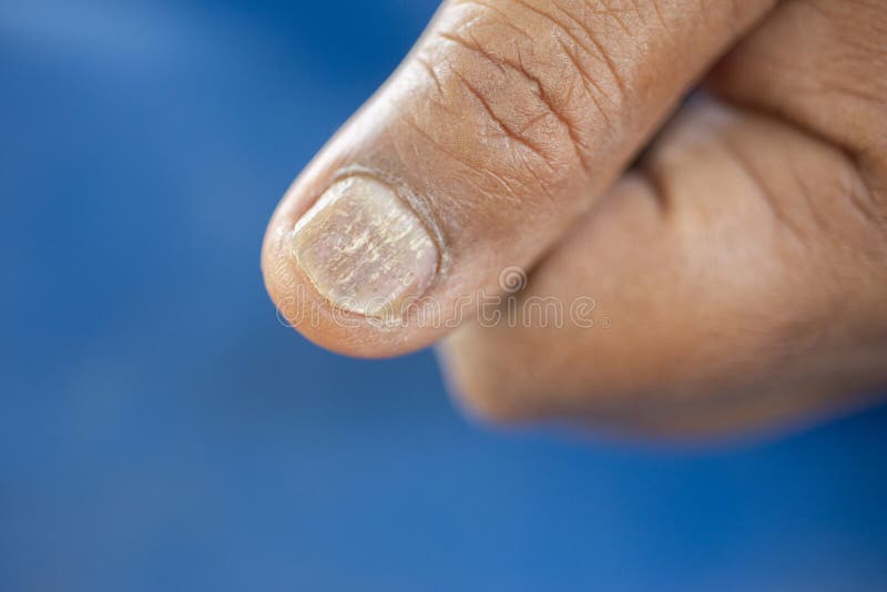 Problematic Nails that are Damaged by Fungus Stock Photo - Image of ...