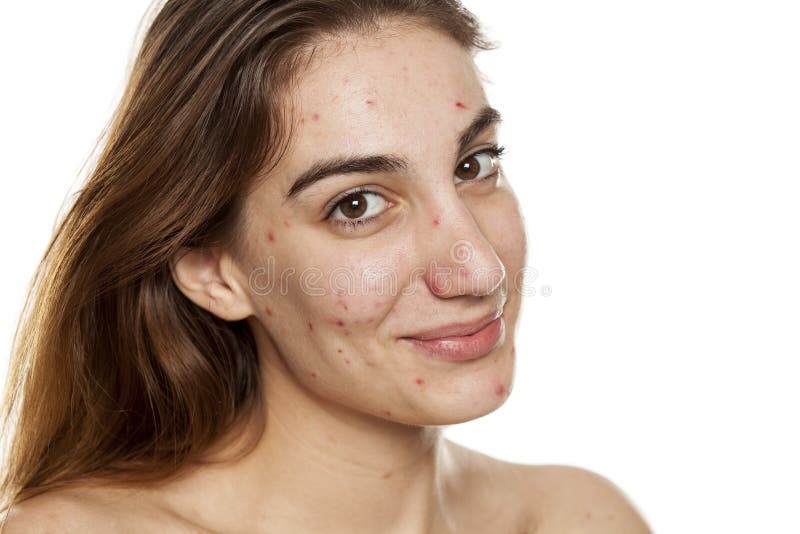 Problematic skin stock photo. Image of problem, beauty - 120024176