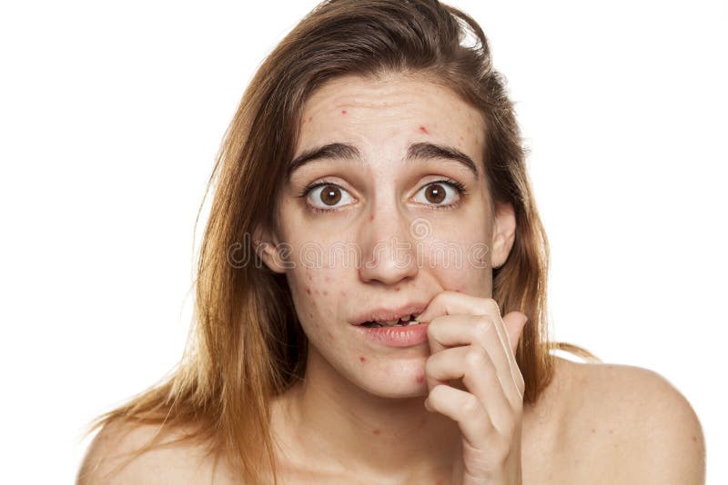 Problematic skin stock image. Image of infection, irritation - 106203299