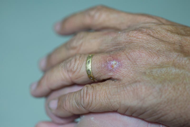 Problems Dry Skin, Wound, Scabs Stock Photo - Image of detail, physique ...