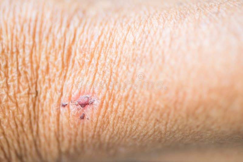 Problems Dry Skin, Wound, Scabs Stock Photo - Image of cracked, coarse ...