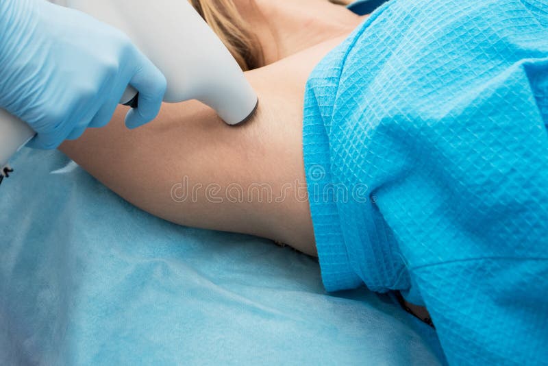 Procedure Against Hyperhidrosis Stock Image - Image of hyperhidrosis ...