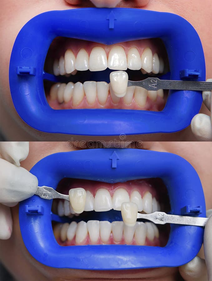 The Procedure for Comparing the Color Shades of Teeth before and after ...