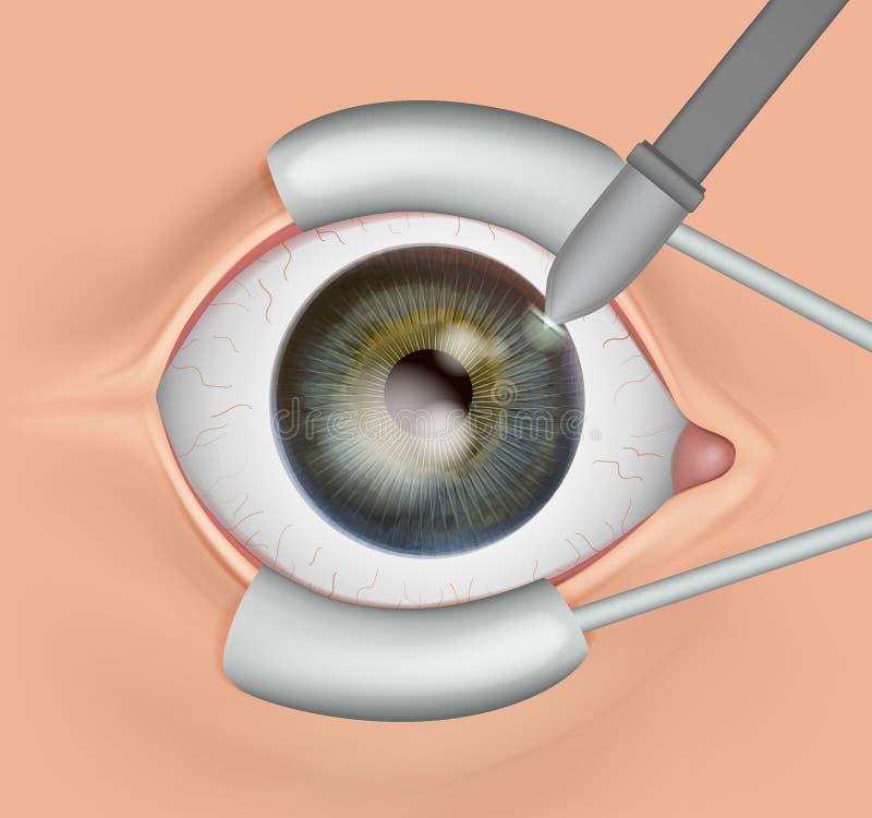 Human Eye Vitrectomy Stock Illustrations – 12 Human Eye Vitrectomy ...