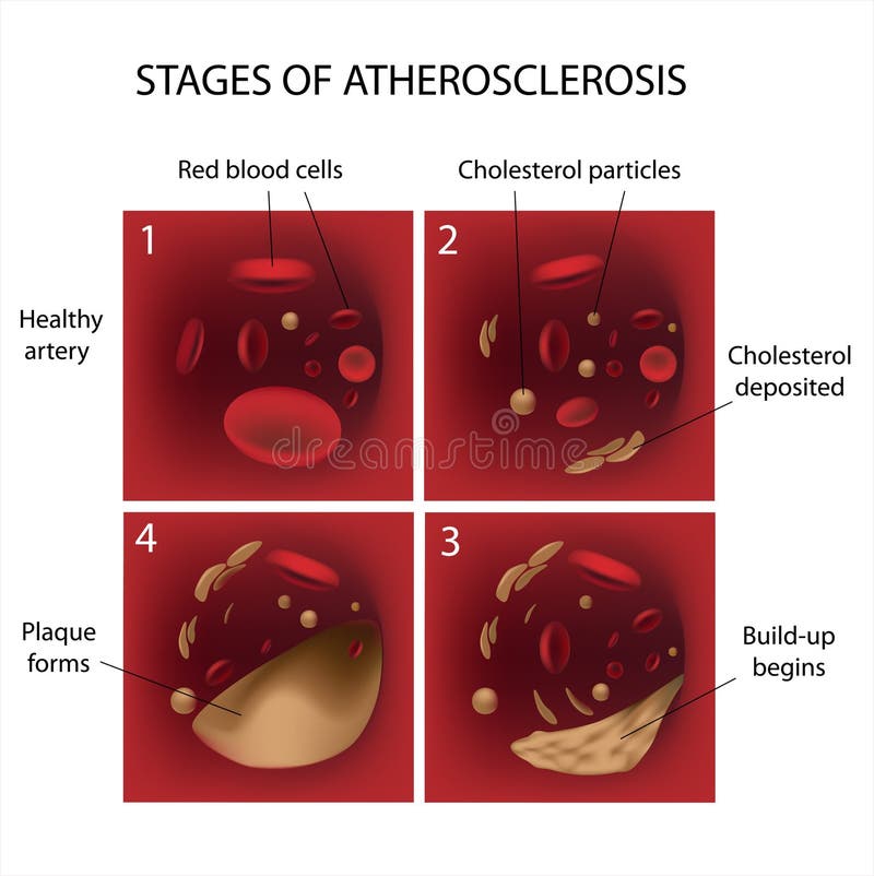 Cholesterol Plaque