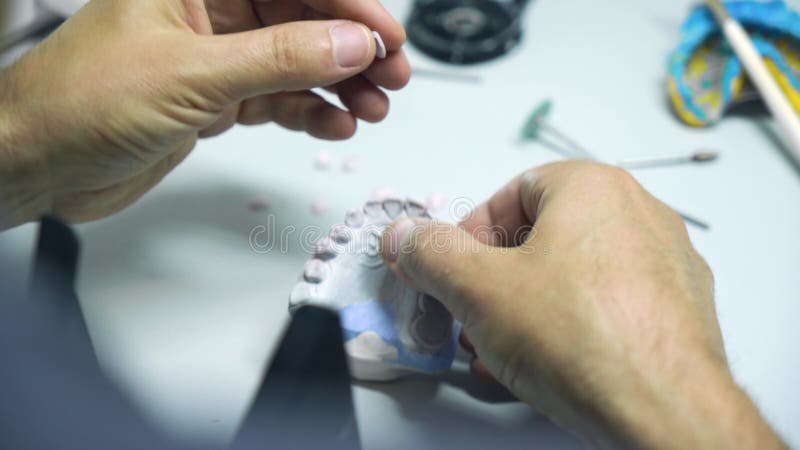 The Process of Creating a Dental Crown and Impression by a Dental ...