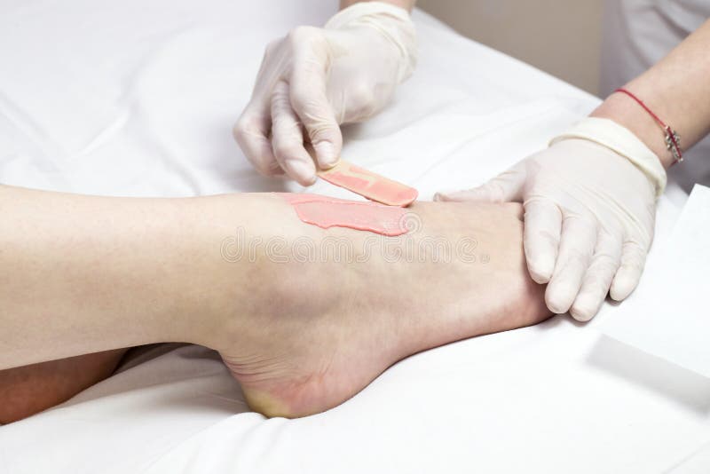 Closeup Depilation Process of Female Body Parts in Beauty Salon. Stock ...