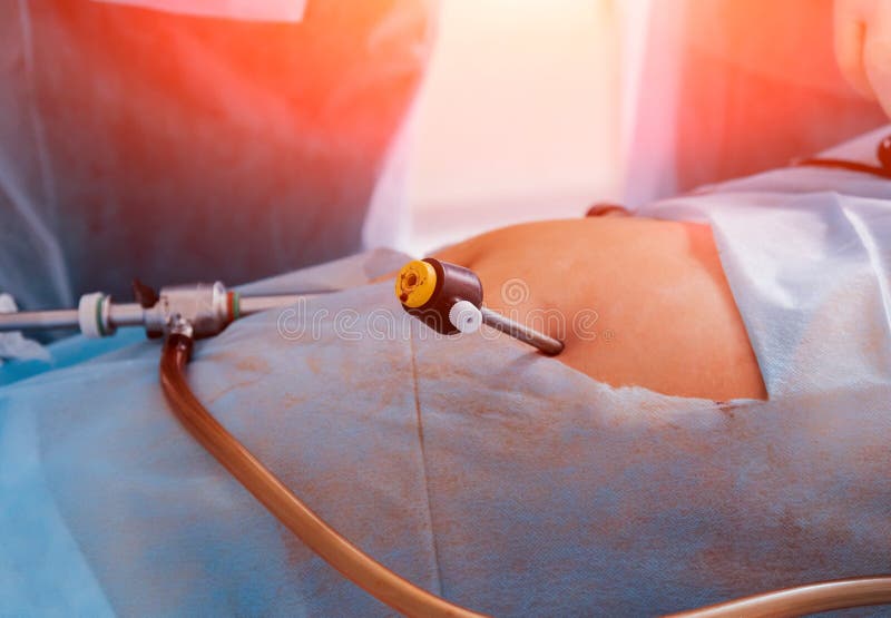 Process of Gynecological Surgery Operation Using Laparoscopic Equipment ...