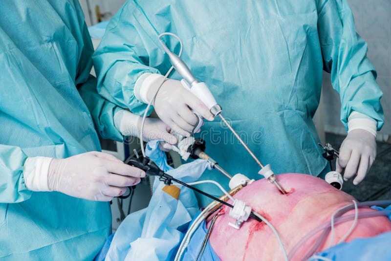 Process of Gynecological Surgery Operation Using Laparoscopic Equipment ...