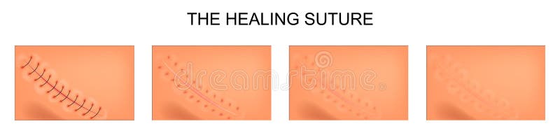 Process of wound healing stock vector. Illustration of injury - 51251717