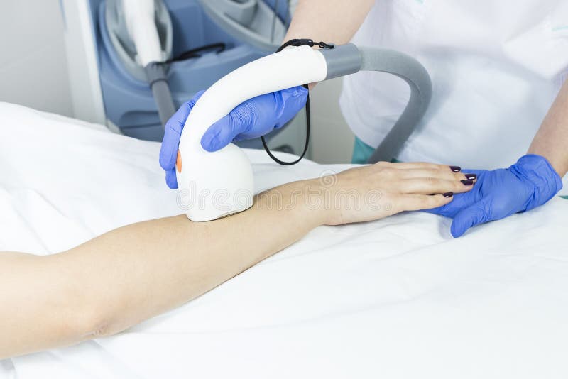 The Process of Laser Depilation of Female Limbs Stock Image - Image of ...