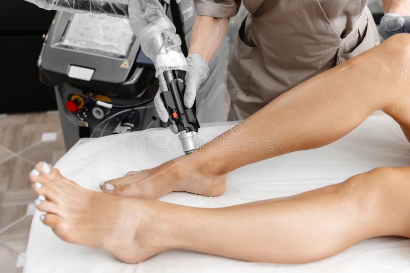 The Process of Laser Hair Removal of Legs in a Large Palm. Hair Removal ...