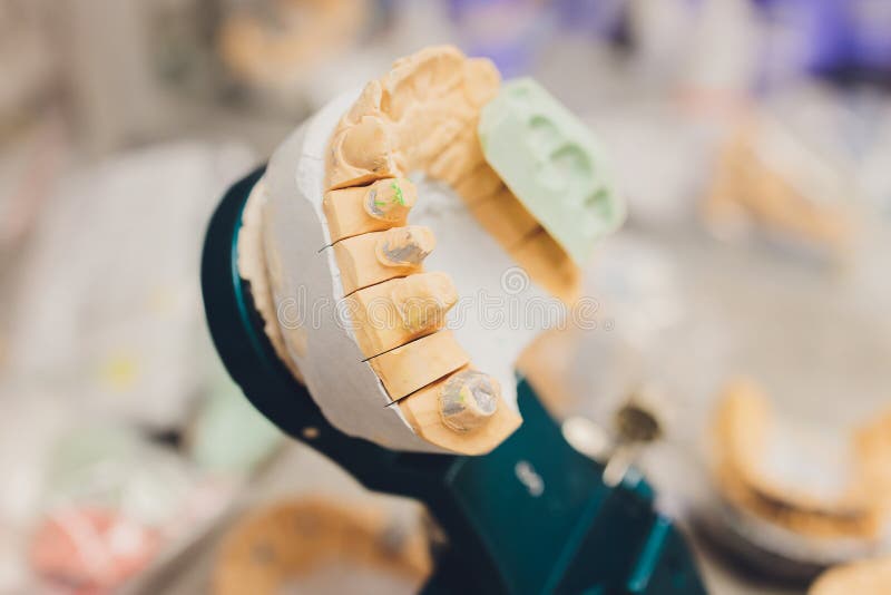 The Process of Making a Dental Prosthesis in a Dental Laboratory. Stock ...