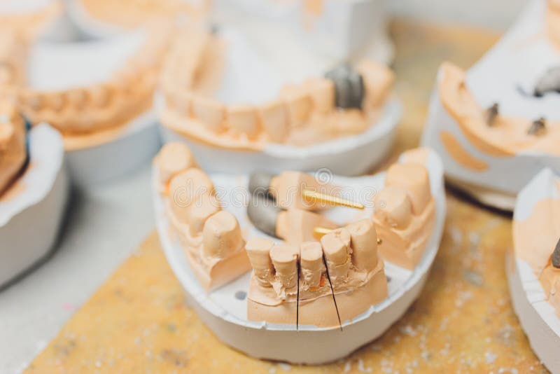 The Process of Making a Dental Prosthesis in a Dental Laboratory. Stock ...