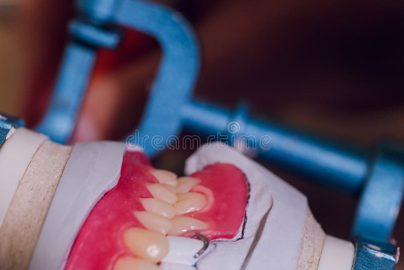 The Process of Making a Dental Prosthesis in a Dental Laboratory. Stock ...