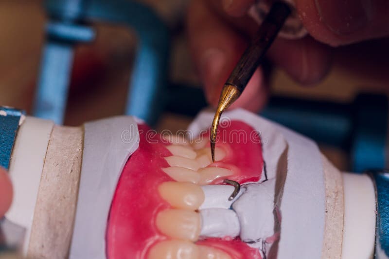 The Process of Making a Dental Prosthesis in a Dental Laboratory. Stock ...