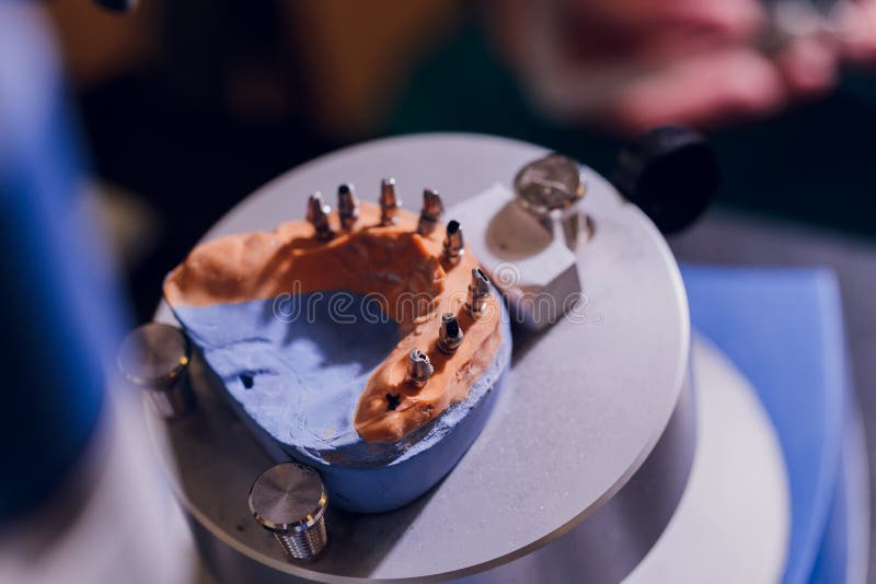 The Process of Making a Dental Prosthesis in a Dental Laboratory. Stock ...