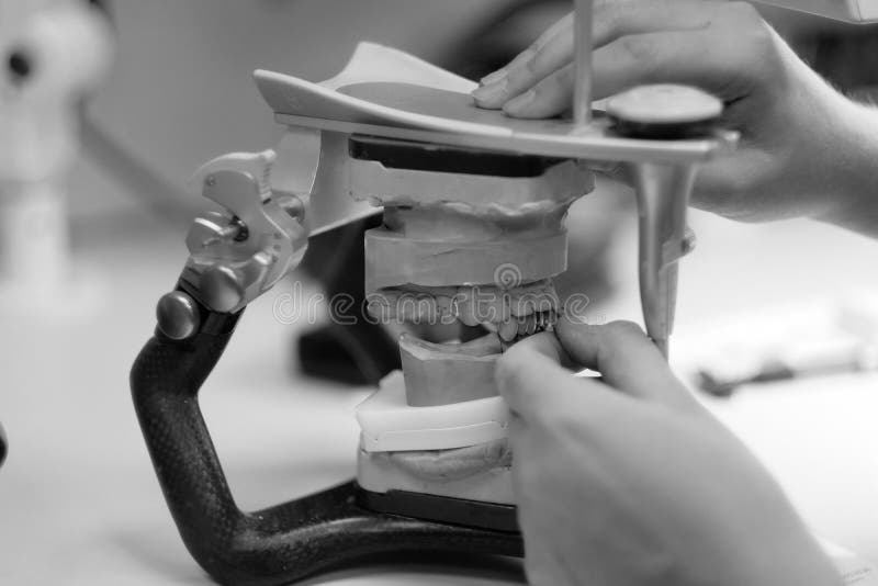 The Process of Manufacturing a Prosthesis Stock Image - Image of dental ...