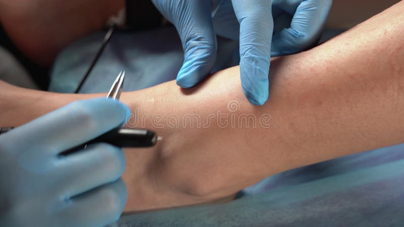 Process of Permanent Unwanted Hair Removal, Using an Electroepilation ...