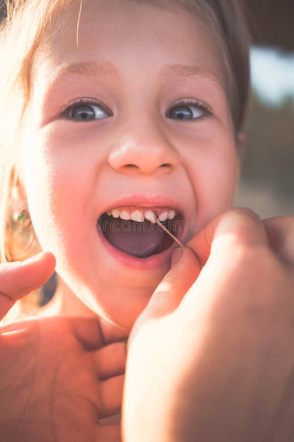 The Process of Removing a Baby Tooth Using a Thread Stock Image - Image ...