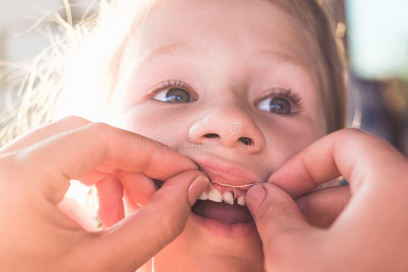 The Process of Removing a Baby Tooth Using a Thread Stock Image - Image ...