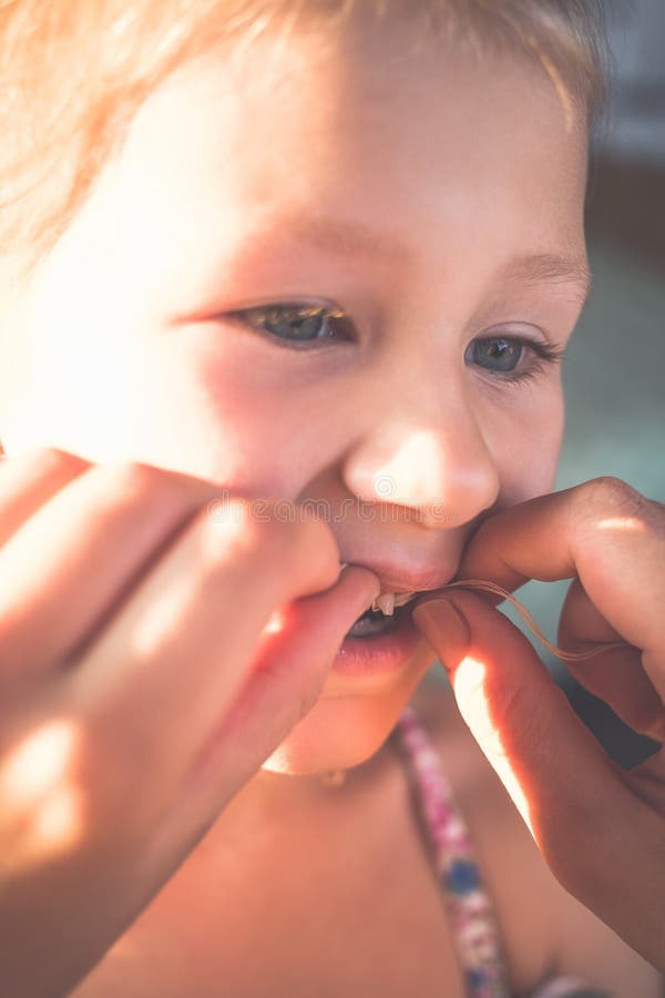 The Process of Removing a Baby Tooth Using a Thread Stock Photo - Image ...