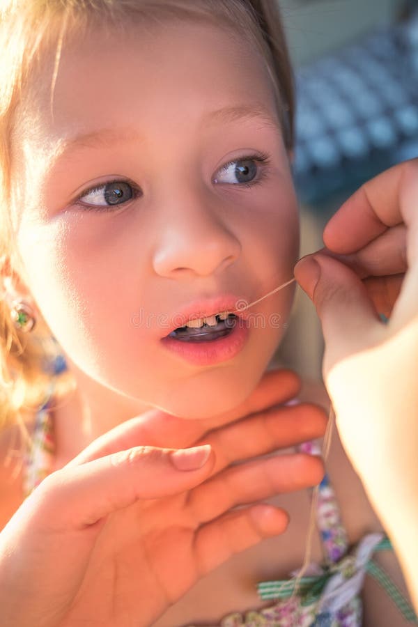 The Process of Removing a Baby Tooth Using a Thread Stock Photo - Image ...