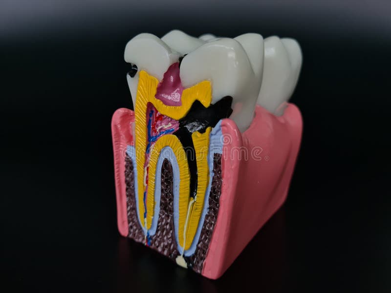 Process of Root Canal Infection and Tooth with Caries Stock Image ...