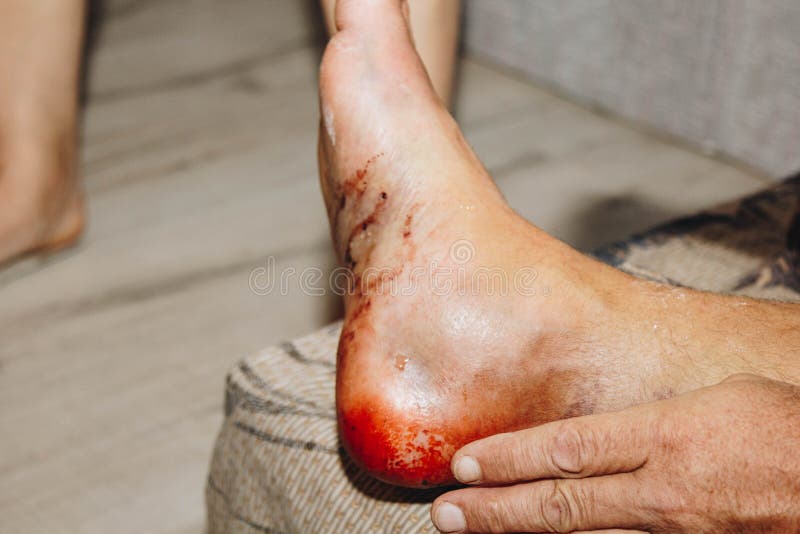 The Process of Treating a Leg Injury at Home. Scar after Surgery. Bone ...